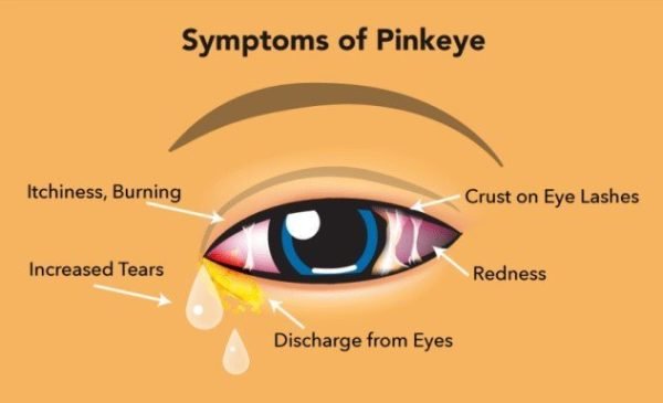Conjunctivitis: Eye Doctor Verified (4 Best At-Home Treatments)