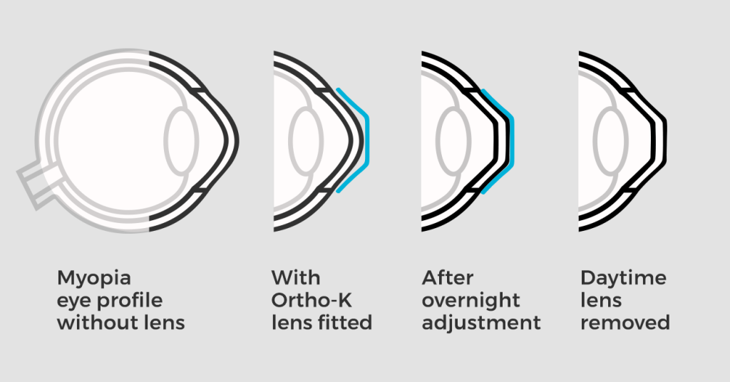 Contact Solution & Lens Care 101: Dos And Don'ts For Healthy Eyes
